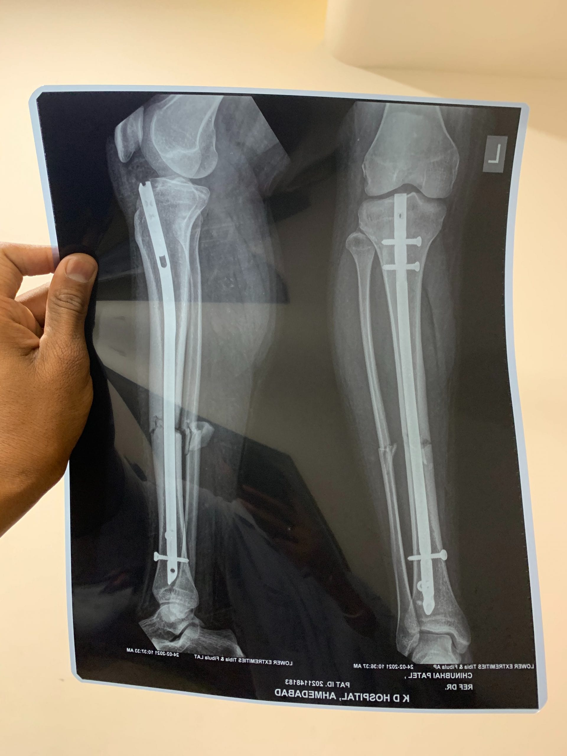 Tendonitis (Bursitis) - Sarasota Arthritis Center